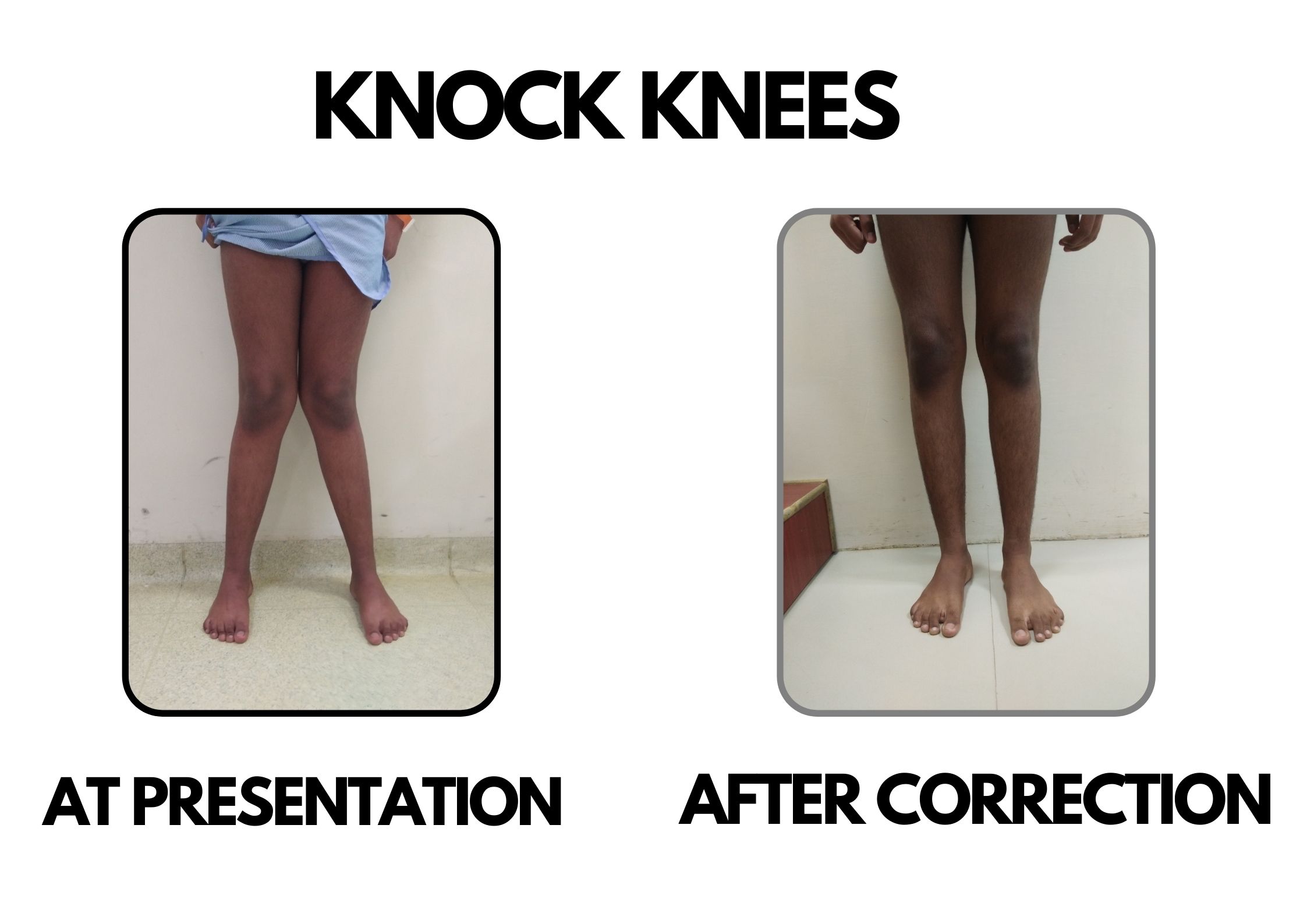 Bowing Knock Knees Dr Deepak Khurana Paediatric Orthopaedic Surgeon